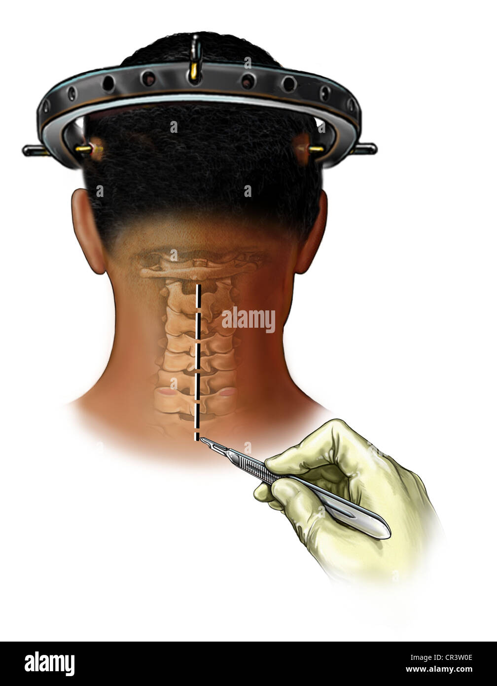 Midline Incision High Resolution Stock Photography and Images - Alamy