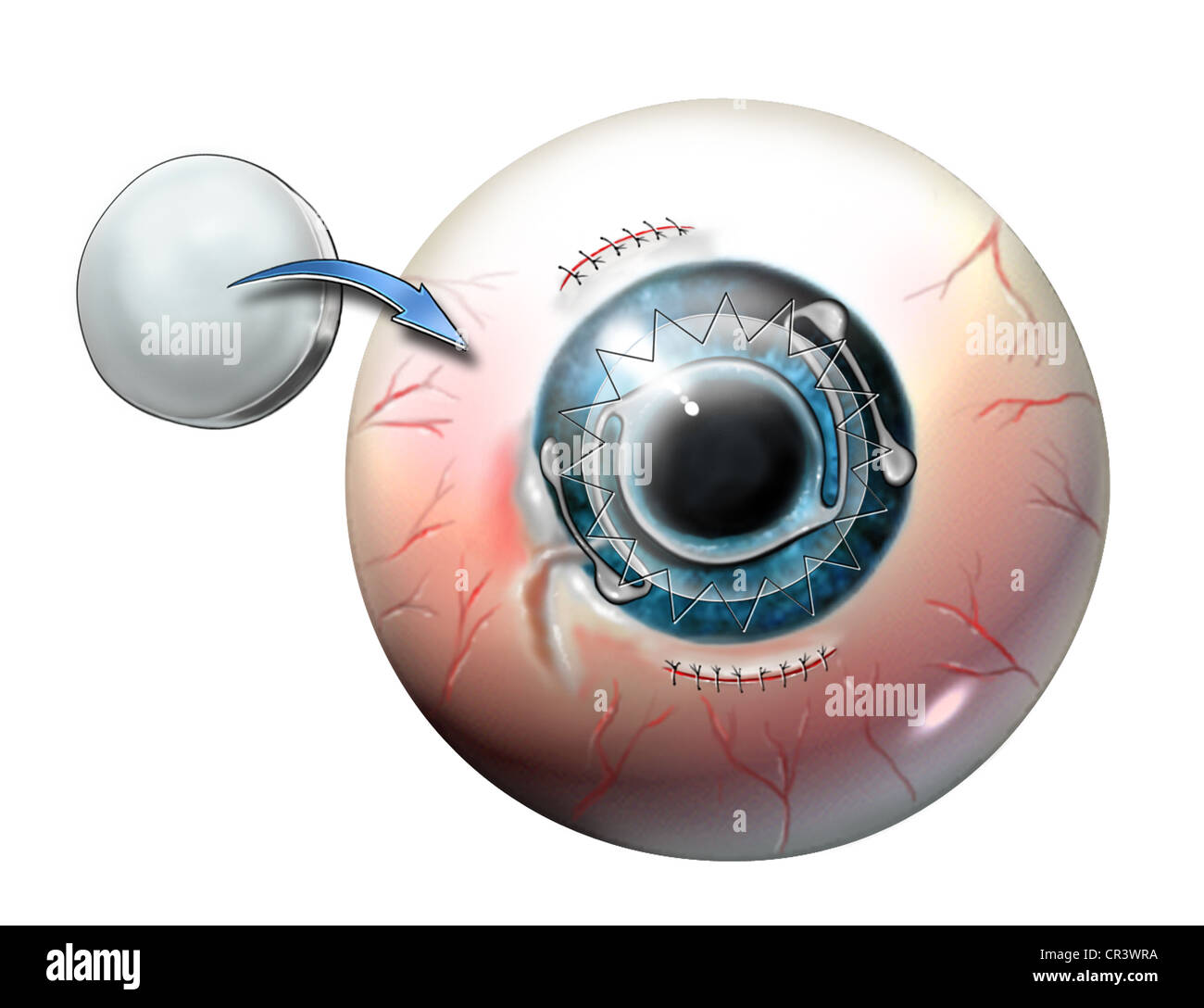 Artificial Lens For Cataract Surgery Stock Photos & Artificial Lens For ...