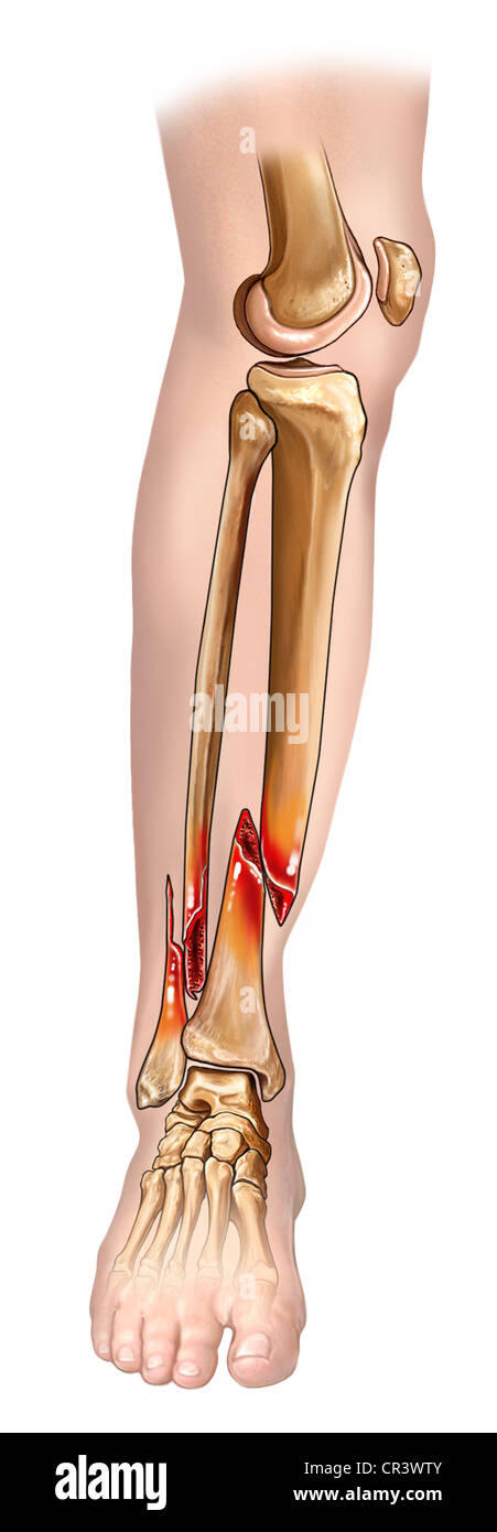 Tibia Fibular Fracture High Resolution Stock Photography and Images - Alamy