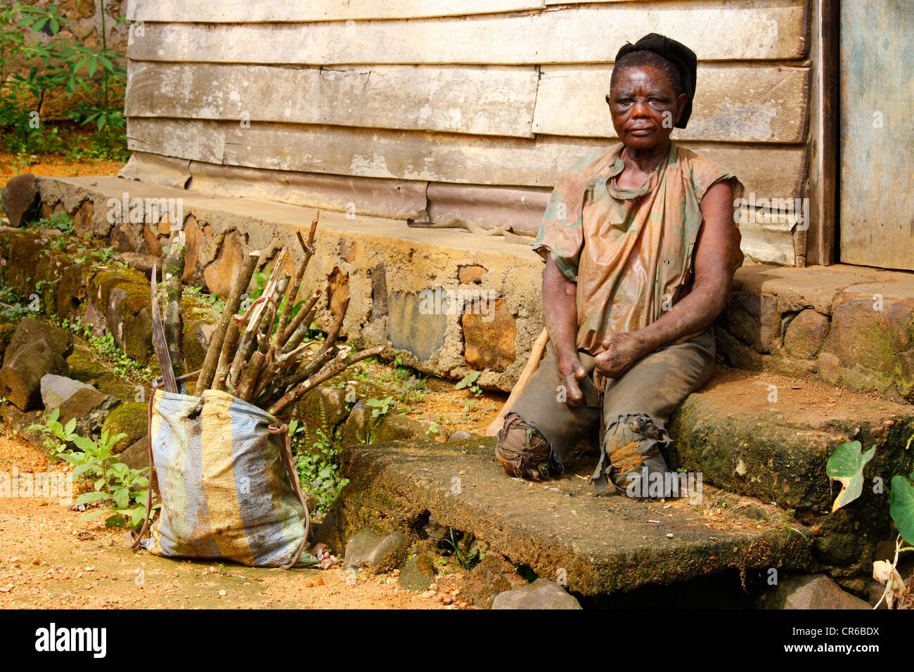 Leprous disease hi-res stock photography and images - Alamy