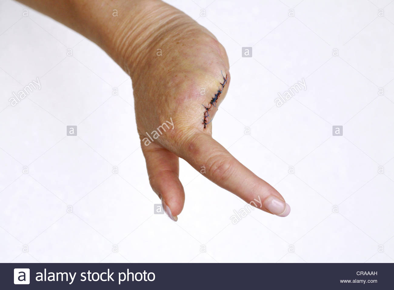 Amputation Amputated Stock Photos & Amputation Amputated Stock Images ...