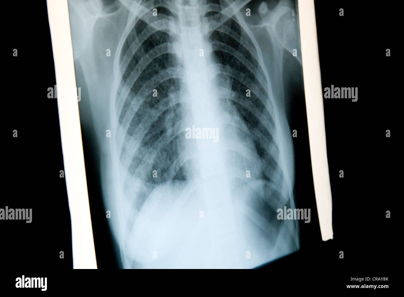Tuberculosis lung x ray hi-res stock photography and images - Alamy