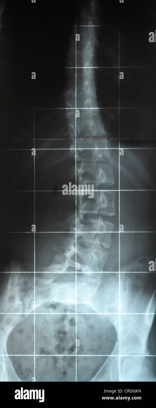 X-ray image of a curved spine due to scoliosis Stock Photo - Alamy