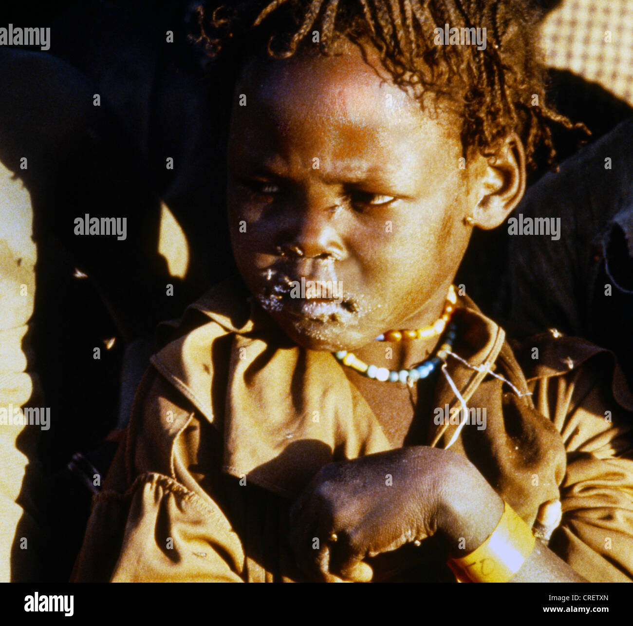 Marasmus hi-res stock photography and images - Alamy