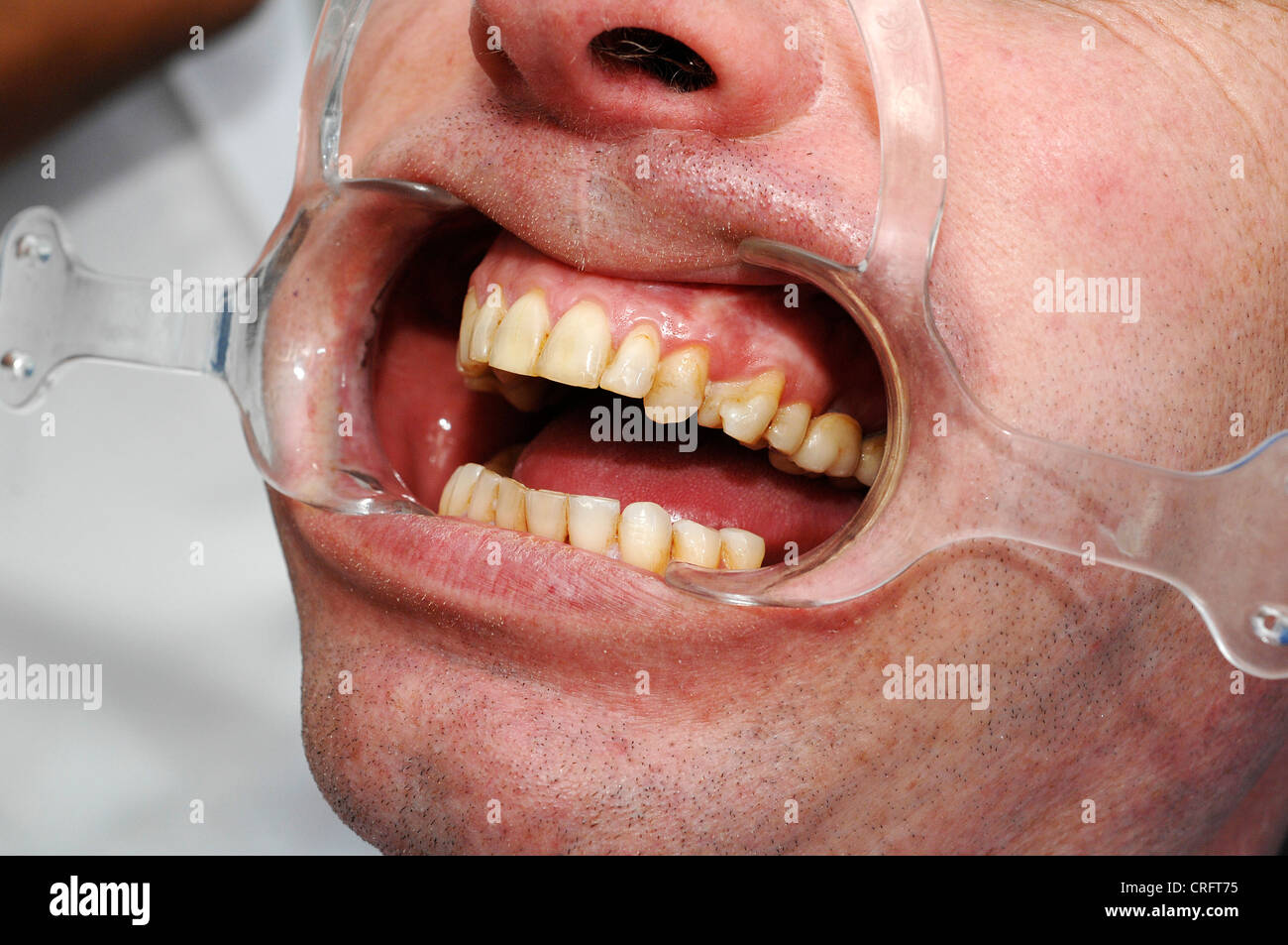 Lip Retractor High Resolution Stock Photography and Images - Alamy