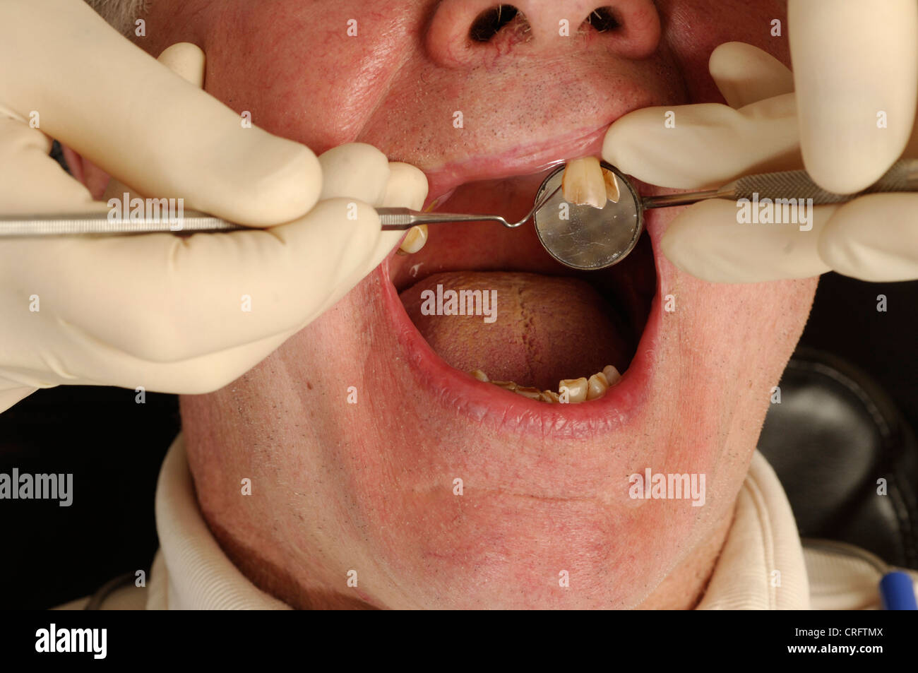 A dentist examines an elderly man's single tooth Stock Photo - Alamy