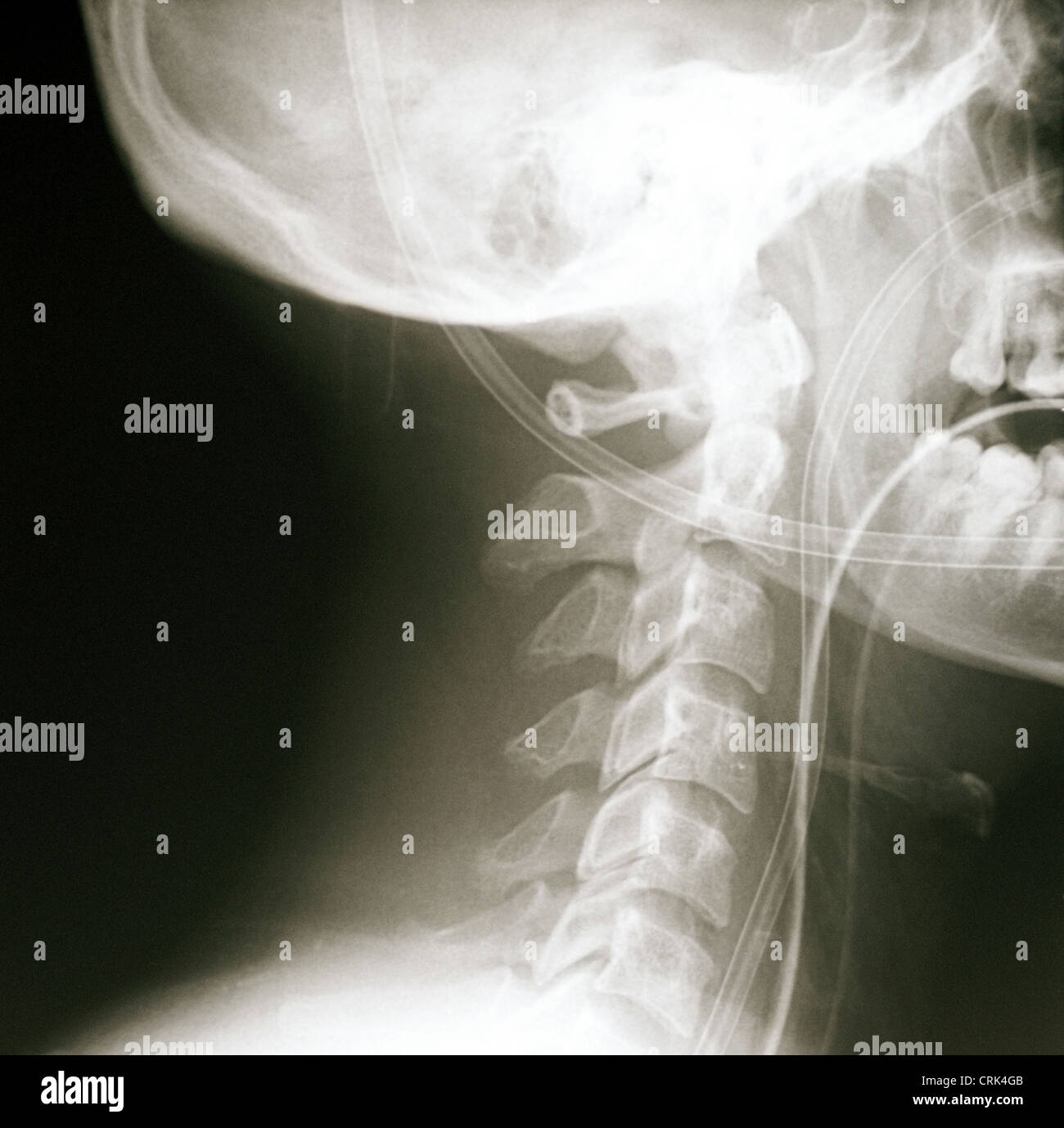 Roentgenfaufnahme one Skull and cervical spine Stock Photo - Alamy