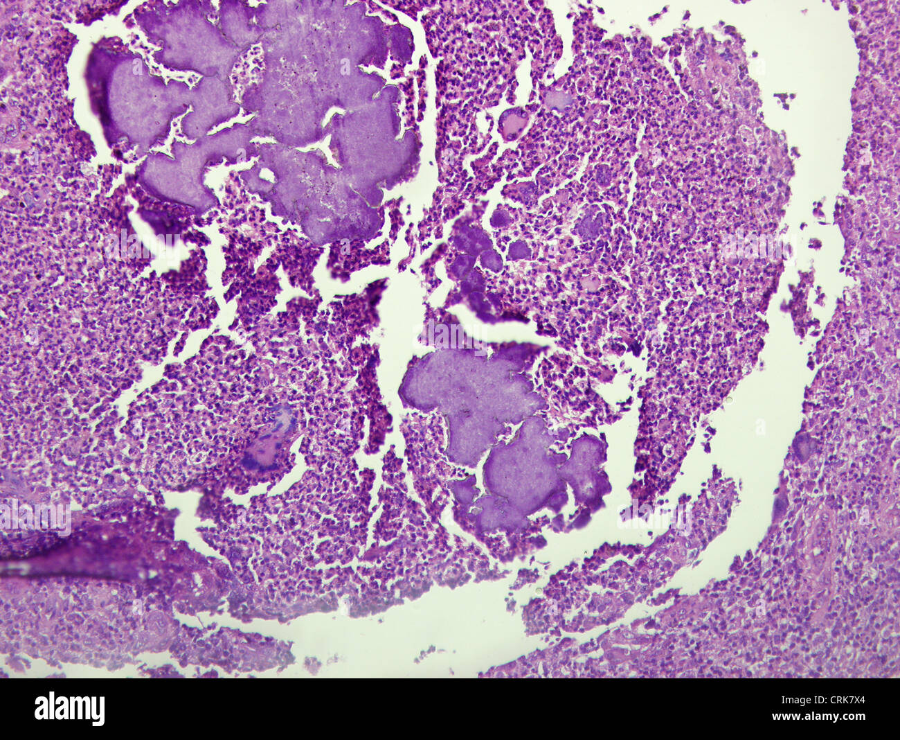 Madura foot hi-res stock photography and images - Alamy