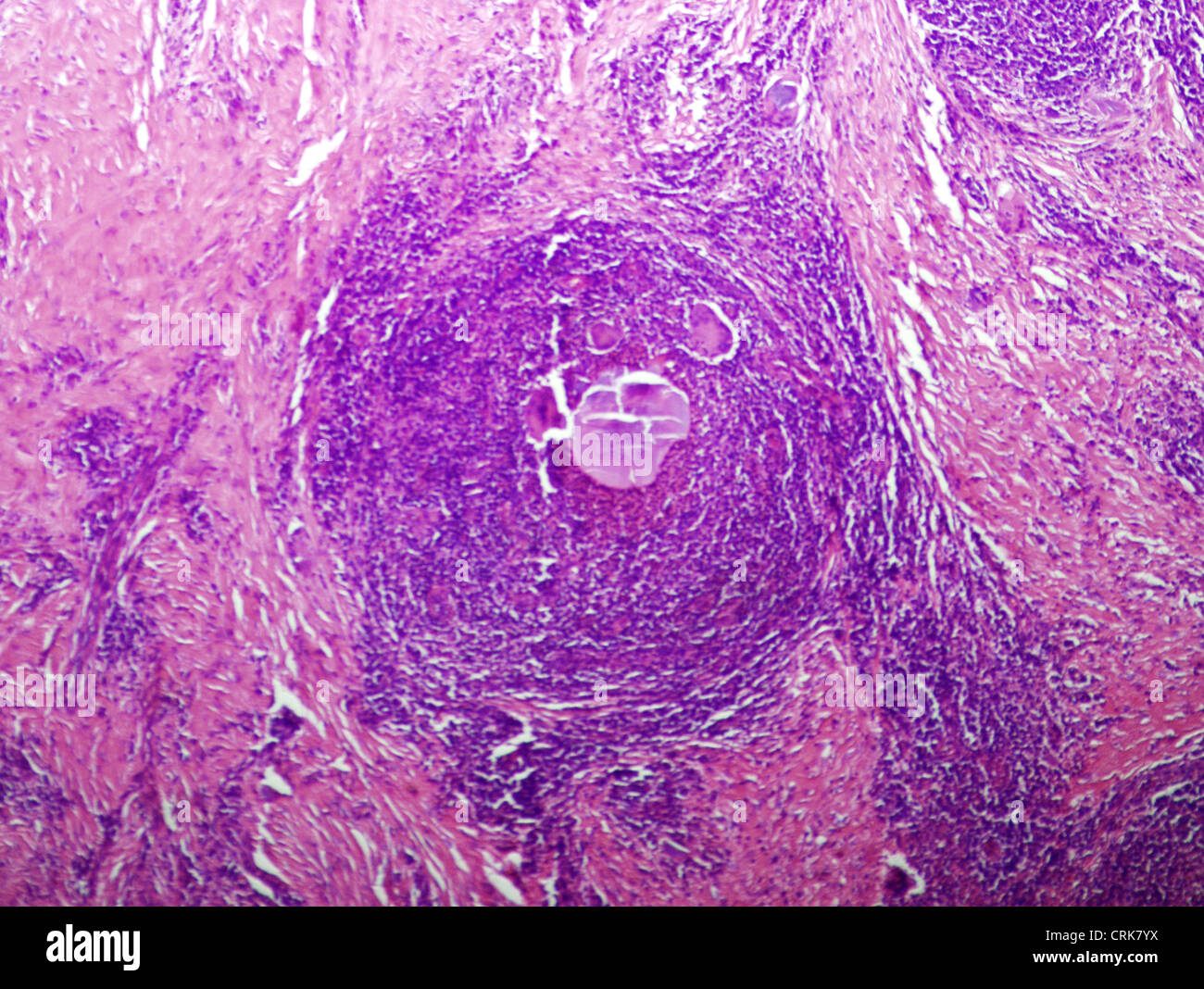 Pseudoallescheria Boydii Swelling Stock Photo - Alamy