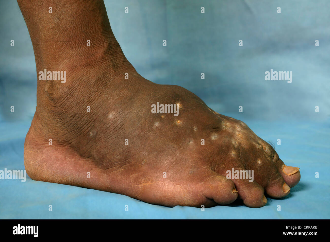 Eumycetoma Stock Photos & Eumycetoma Stock Images - Alamy
