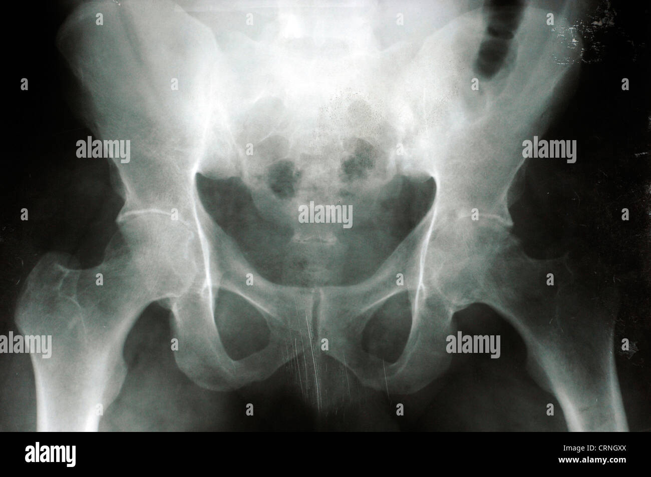 Pelvis anatomy hi-res stock photography and images - Alamy
