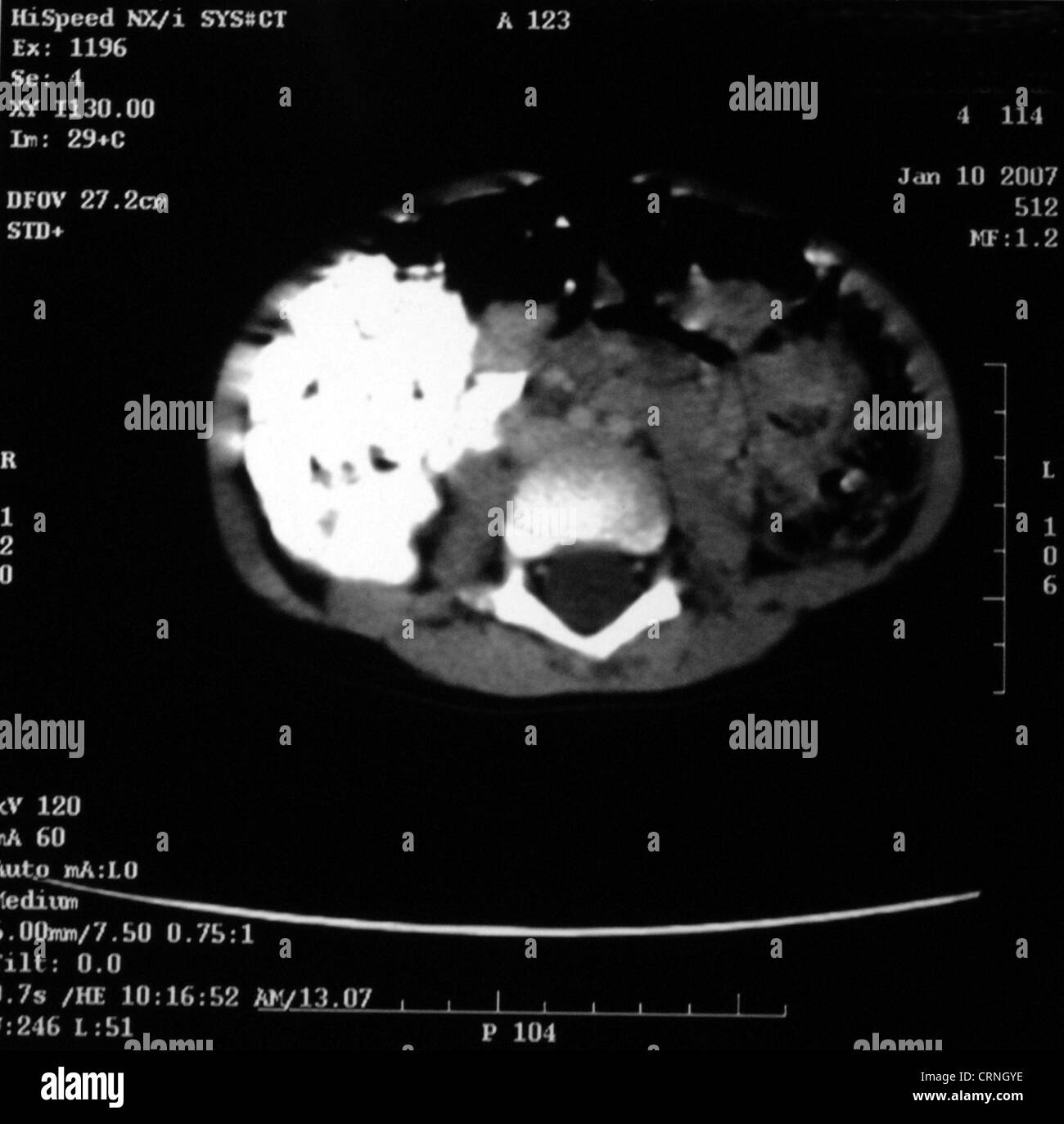 Chest ct scan hi-res stock photography and images - Alamy