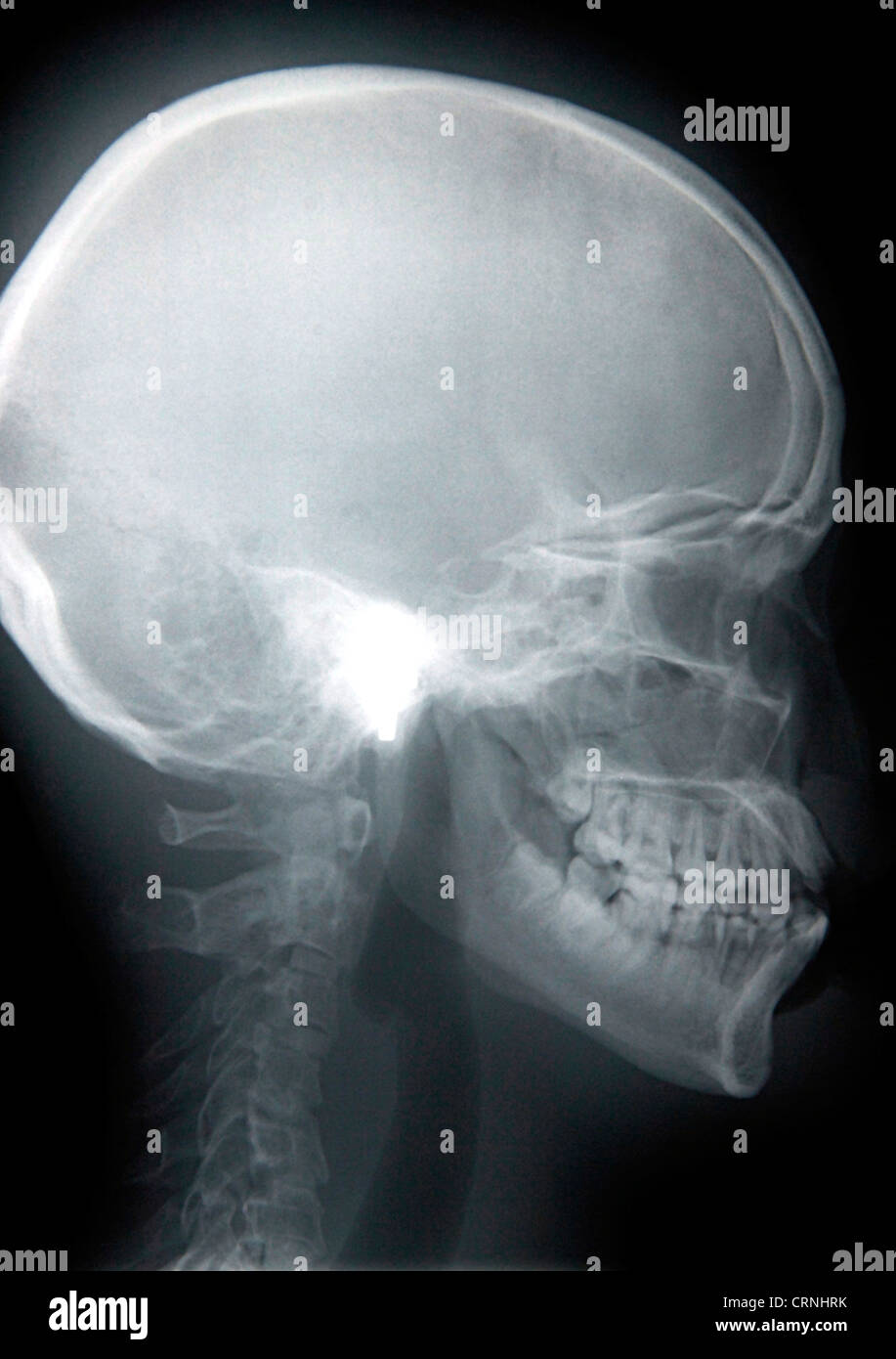 Skull xray hi-res stock photography and images - Alamy