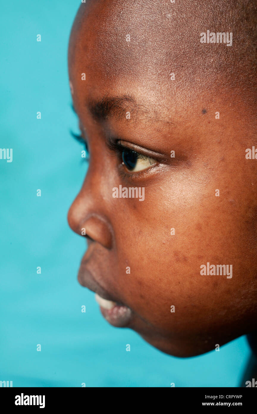 Side view of the face of a 12 year old girl suffering from nephritic ...