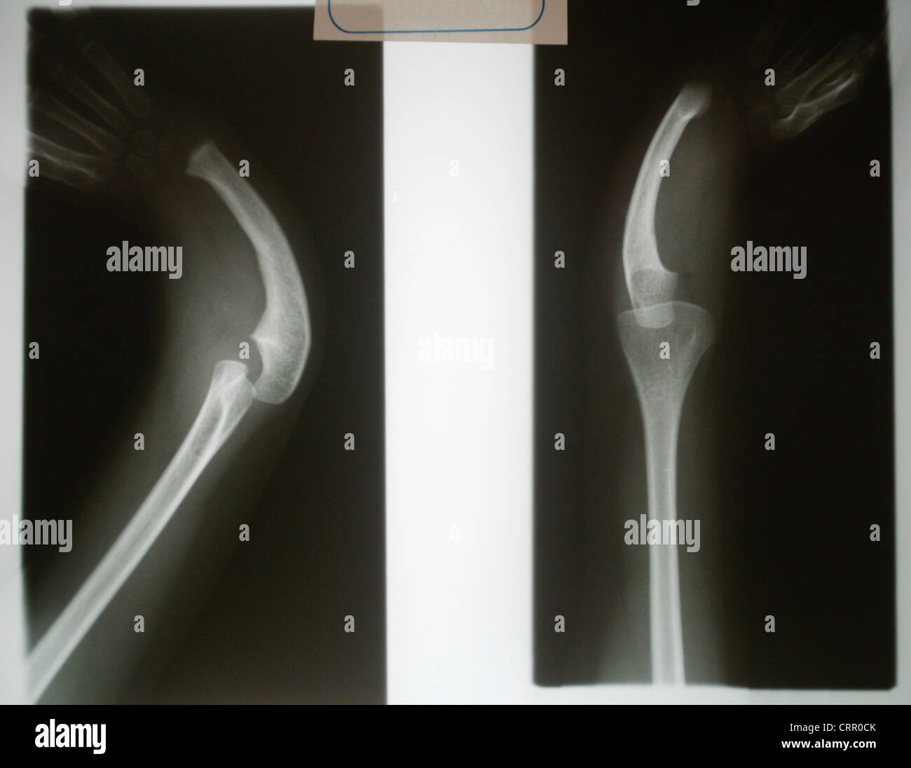 X-ray of a child with TAR syndrome Stock Photo - Alamy