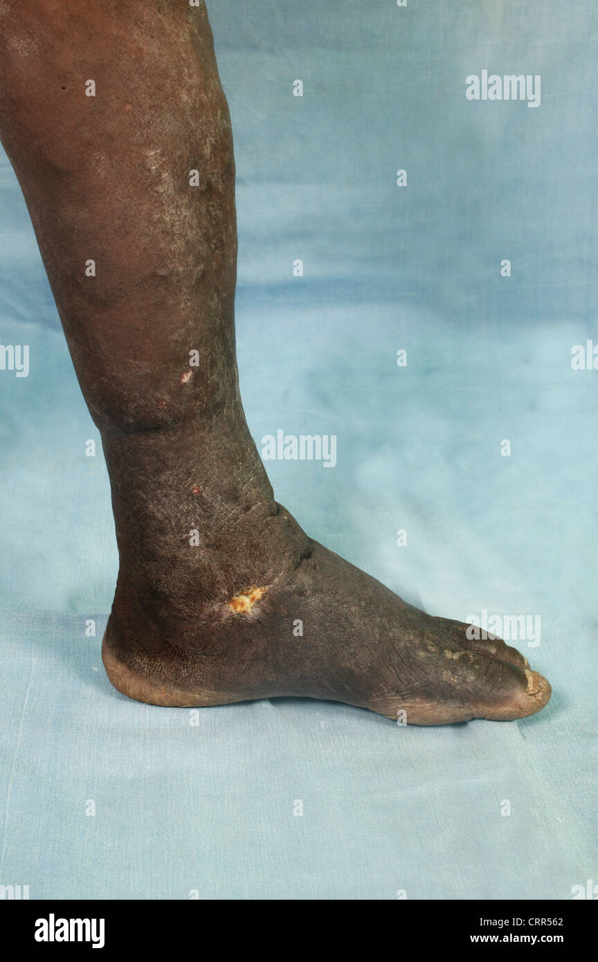 Swelling on left ankle Stock Photo - Alamy