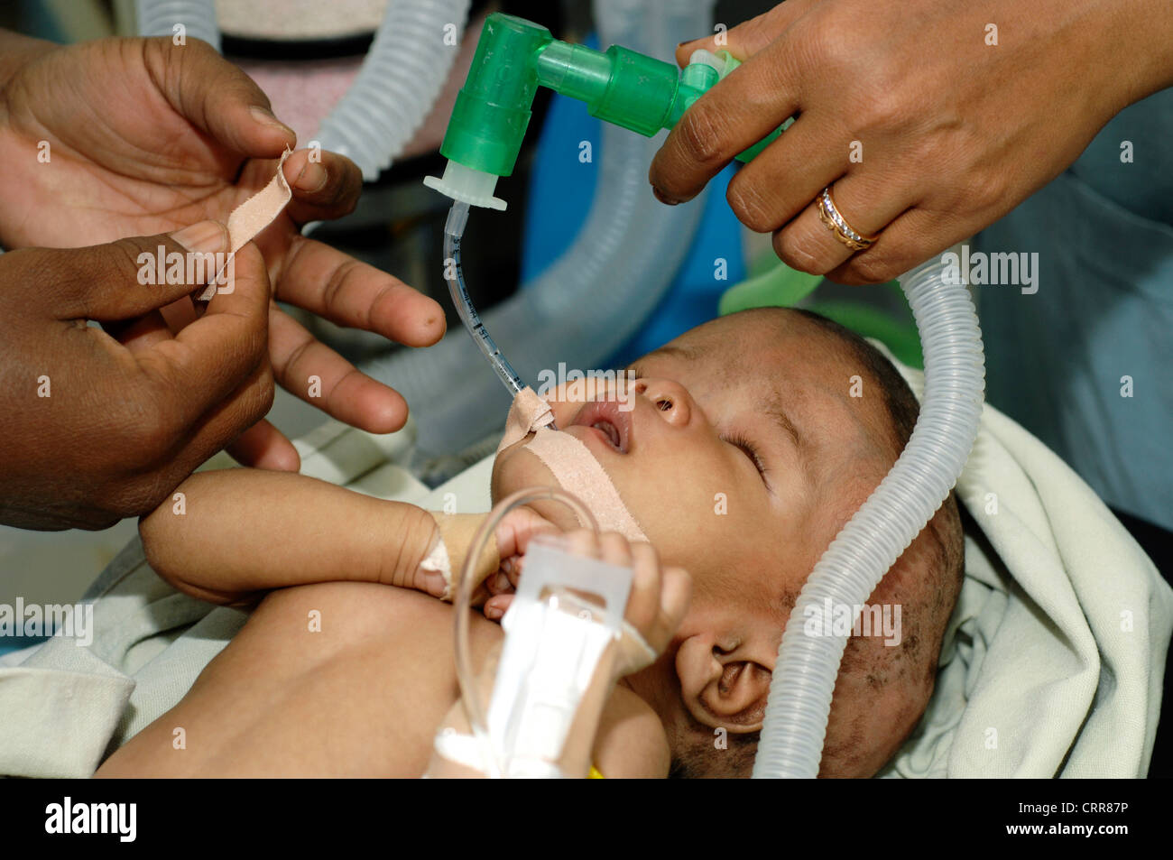 Hydrocephalus in infant hi-res stock photography and images - Alamy