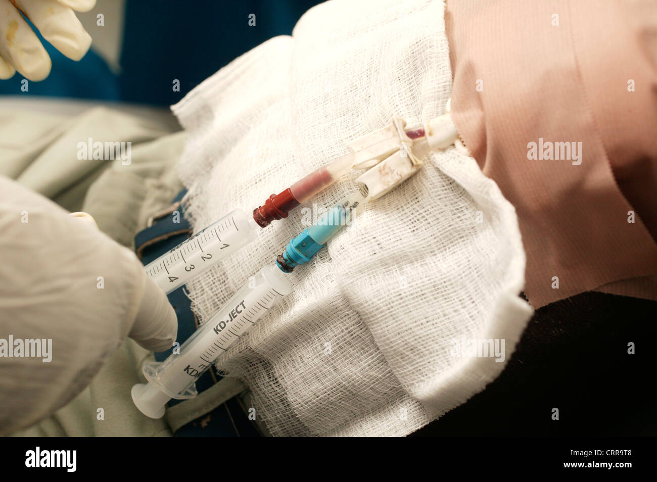 A nurse prepares the cannula on a patient before connecting to a ...