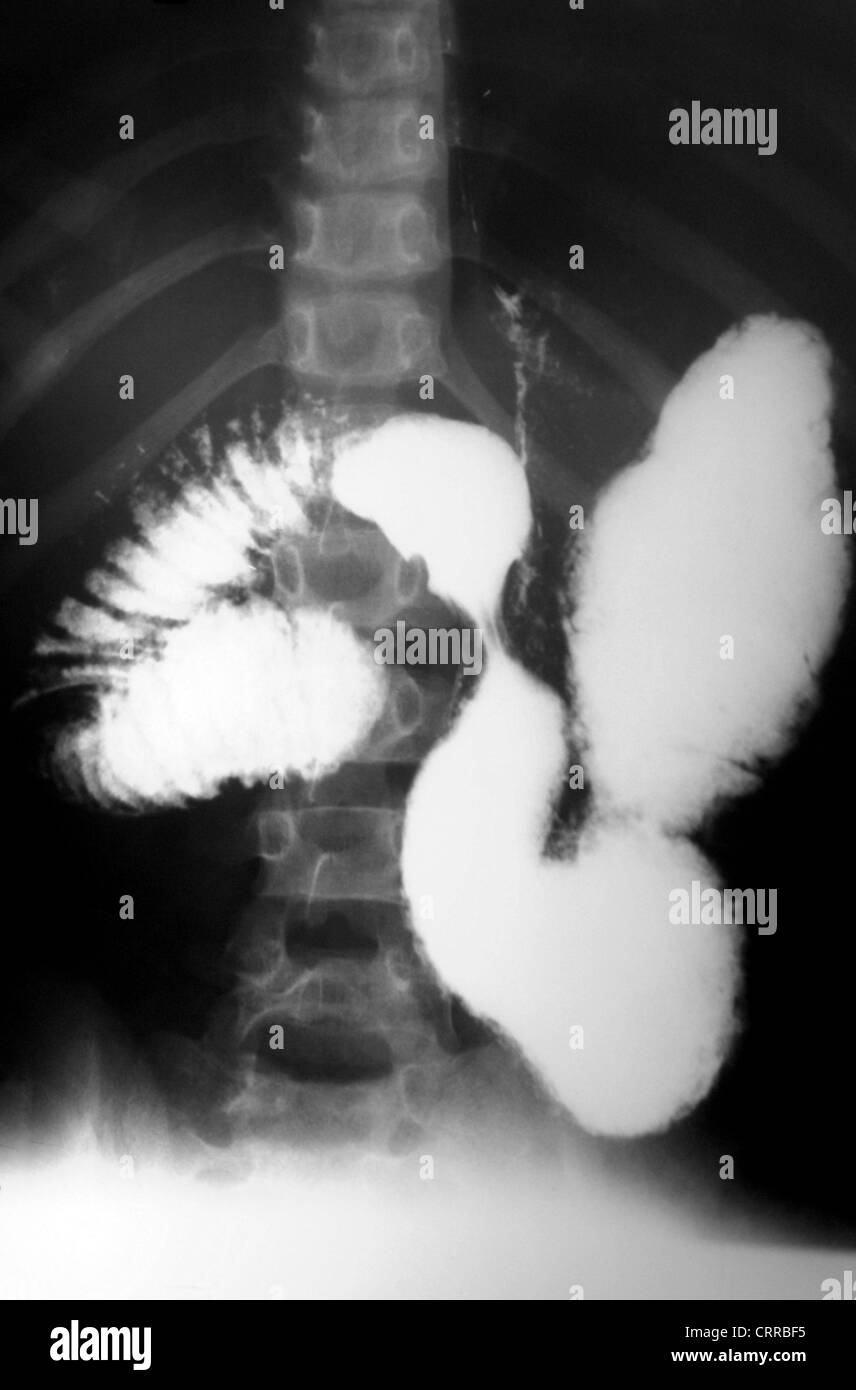 A barium study revealing a patient's stomach and duodenum Stock Photo ...