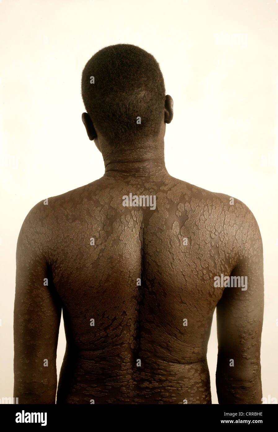 Back Condition Dermatological Stock Photo - Alamy