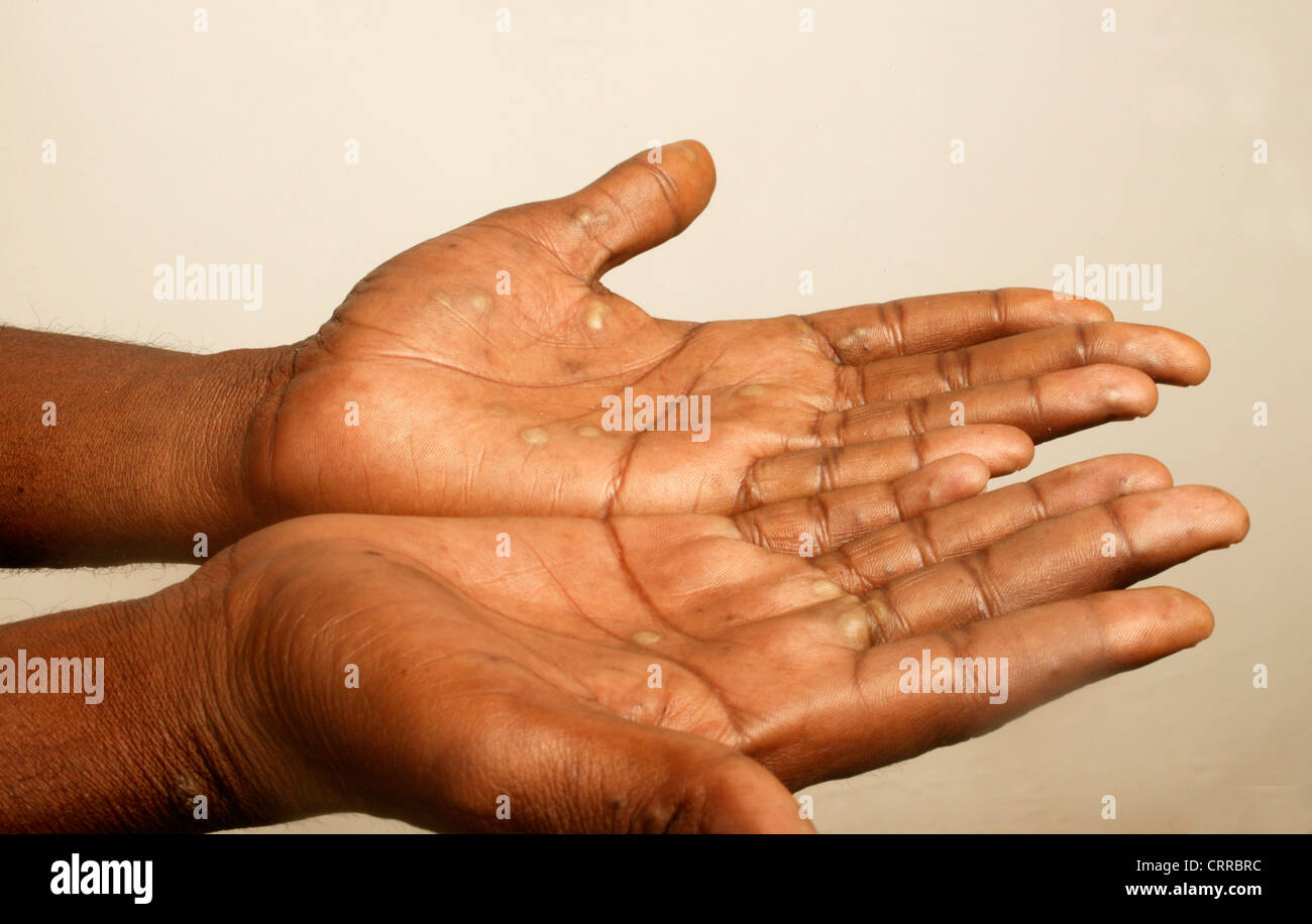 Close-up of the hands of a 30-year-old male suffering from Erythema ...