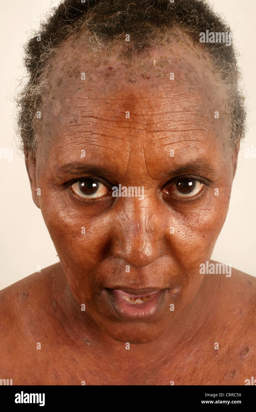 Disease dermatology skin pemphigus vulgaris hi-res stock photography ...