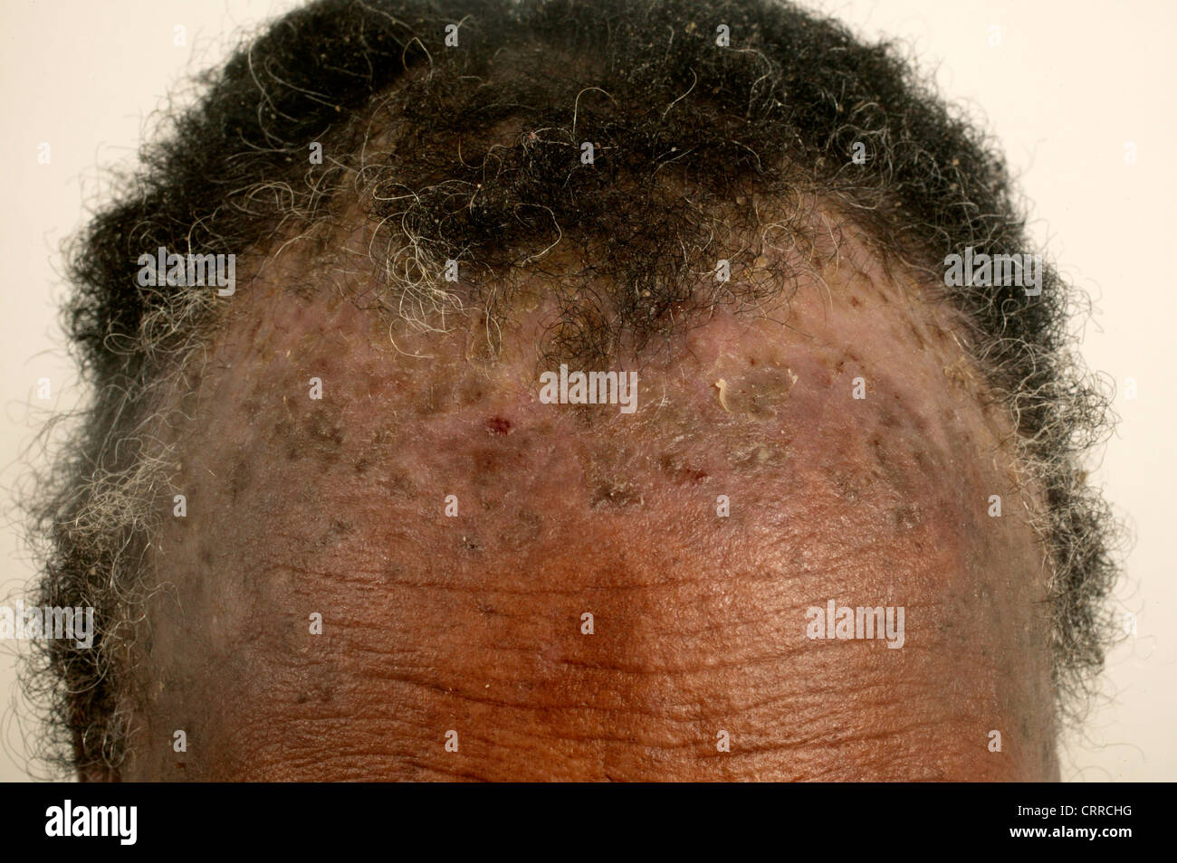 Pemphigus Foliaceus Scalp
