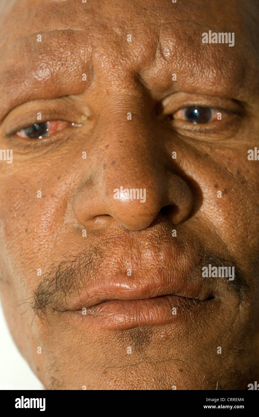 Sebum hi-res stock photography and images - Alamy