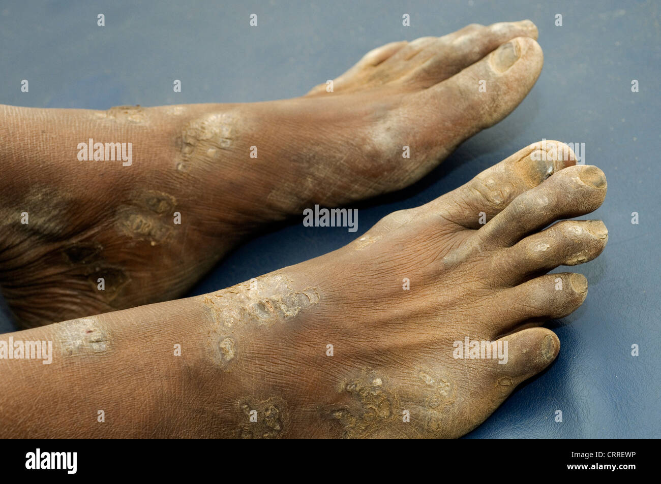 Scaly skin woman hi-res stock photography and images - Alamy