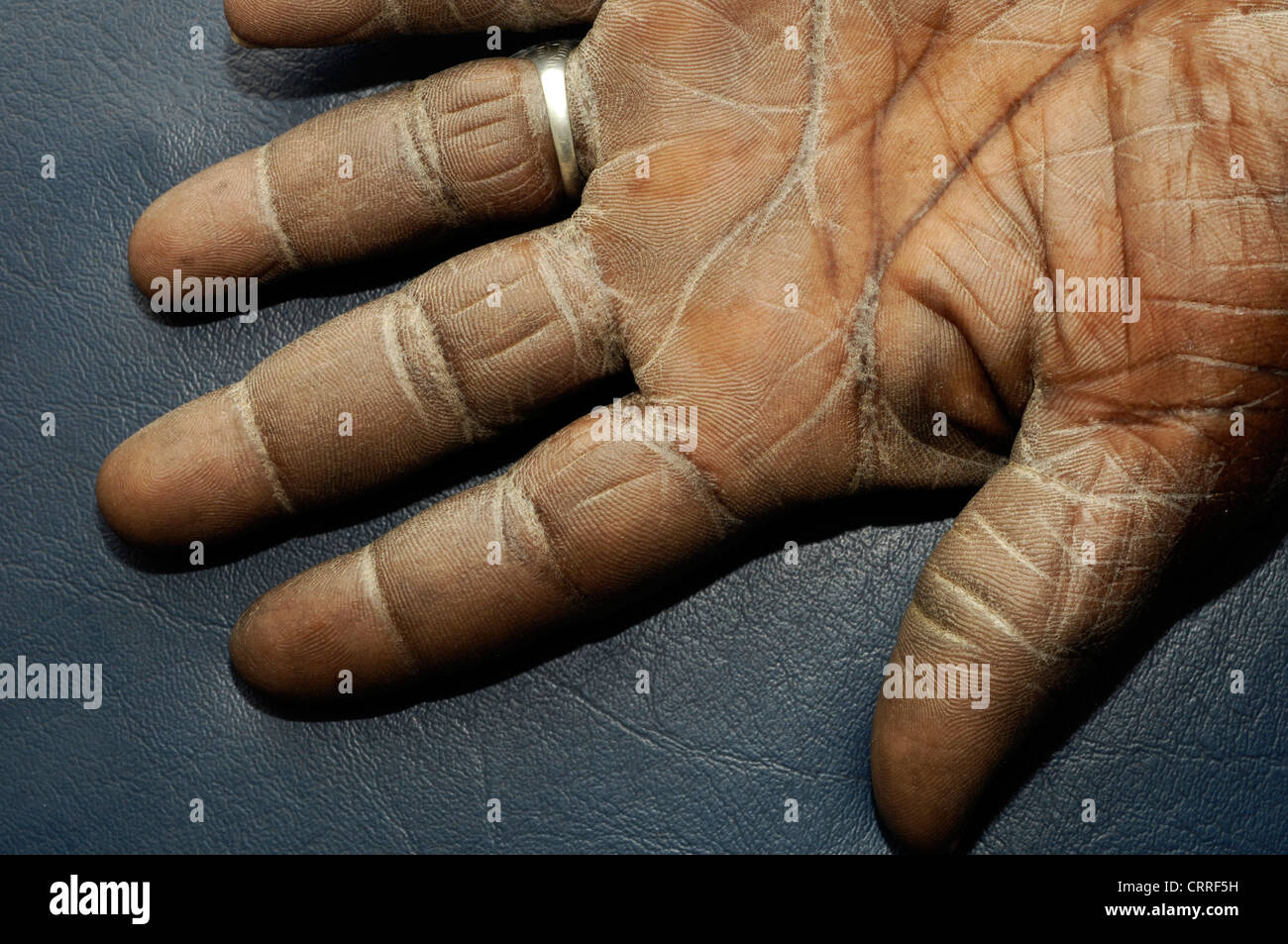 A patient with ichthyosis vulgaris affecting his hand Stock Photo - Alamy