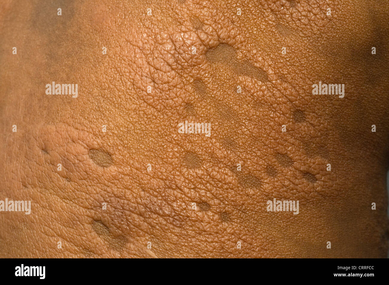 A man develops several small plaques on his torso. The cause is unknown ...