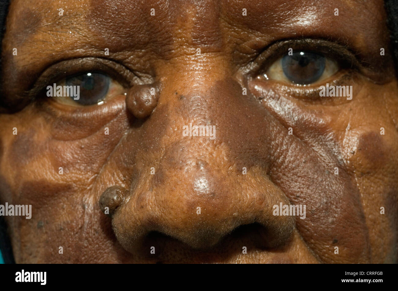 A woman with a rash which may be pityriasitic in origin Stock Photo - Alamy