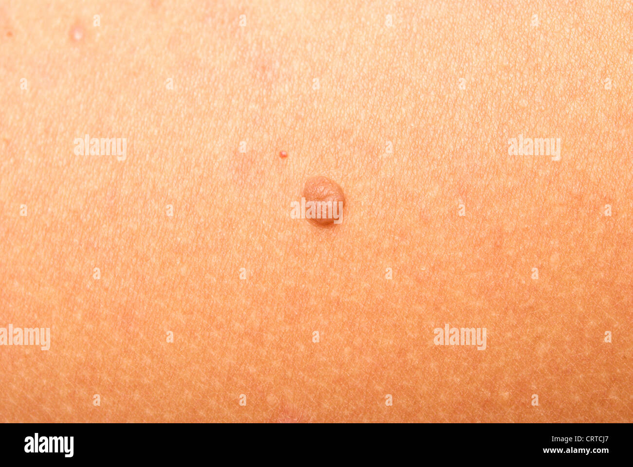 Skin mole hi-res stock photography and images - Alamy