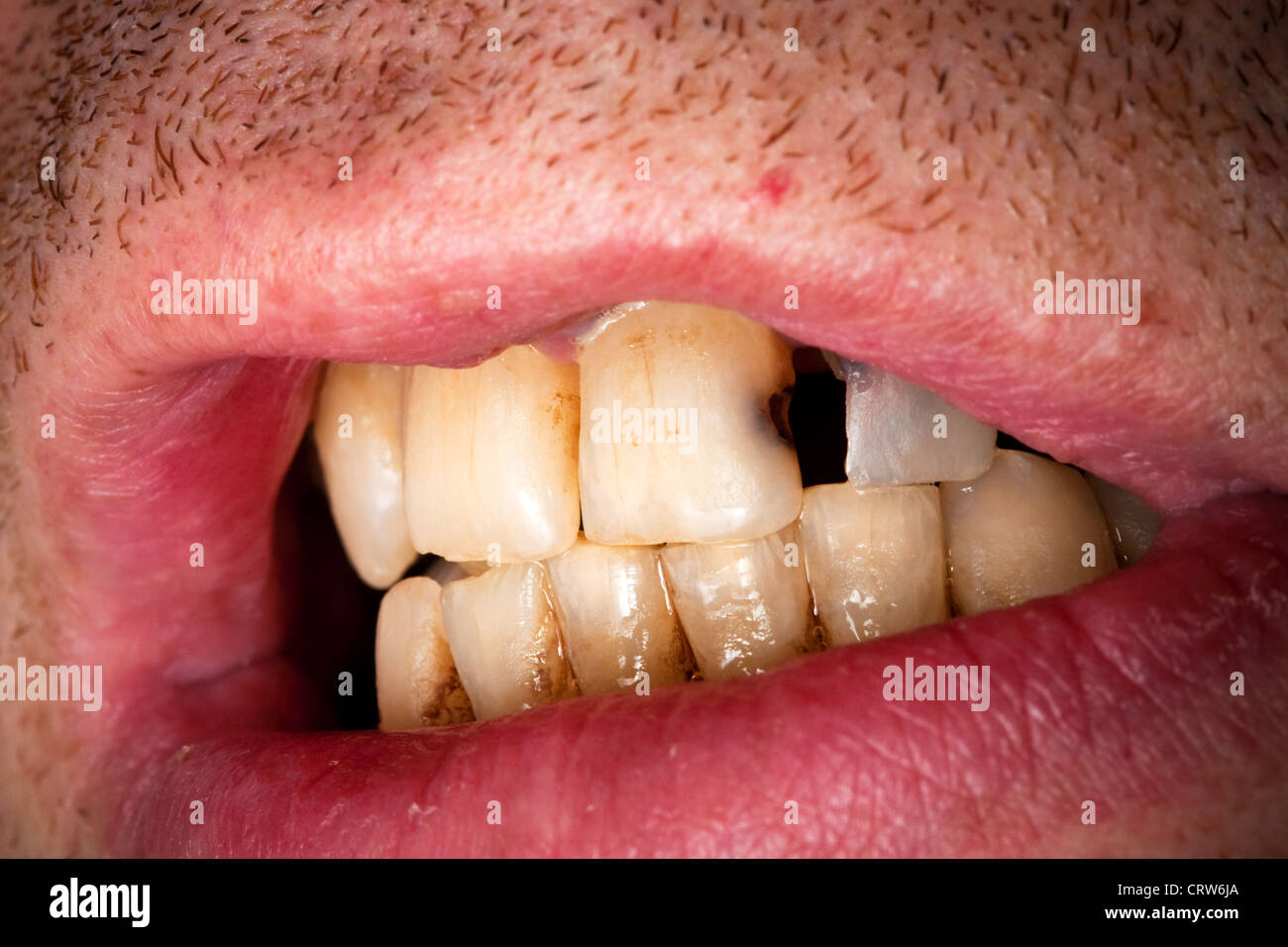 Sick Tooth High Resolution Stock Photography and Images - Alamy