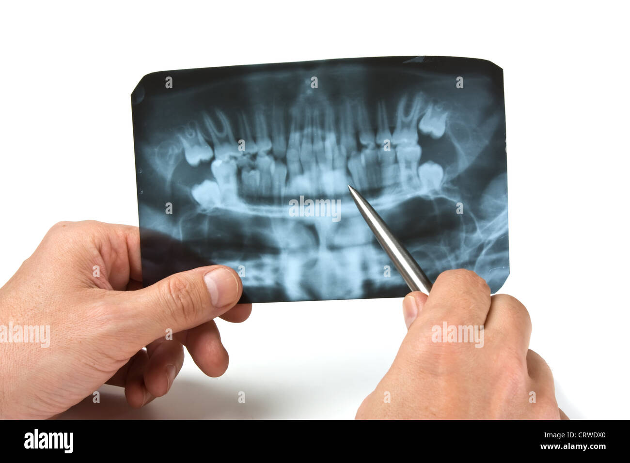 X ray radiograph hand hi-res stock photography and images - Alamy