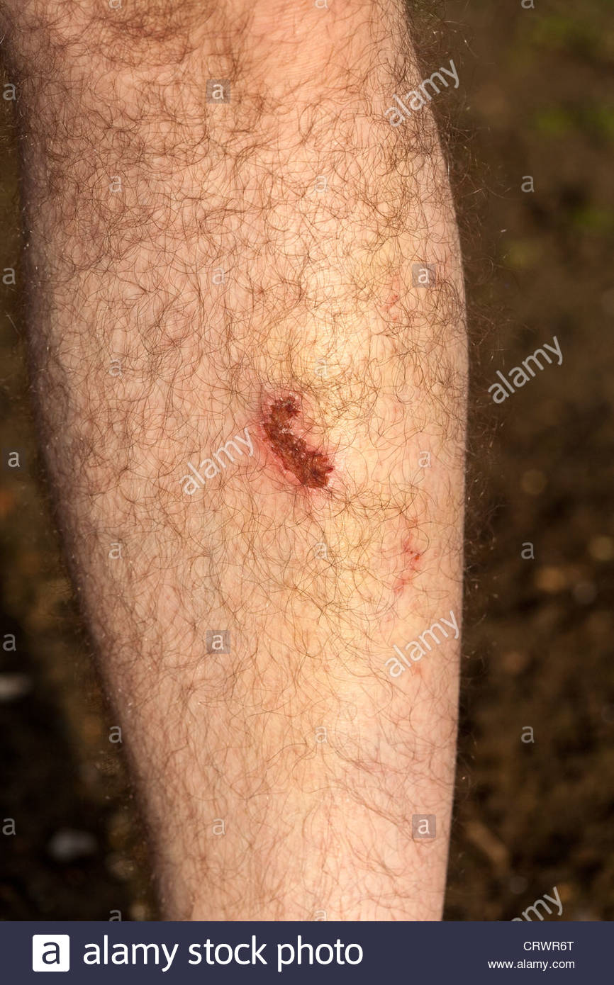 Grazed Knee High Resolution Stock Photography and Images - Alamy