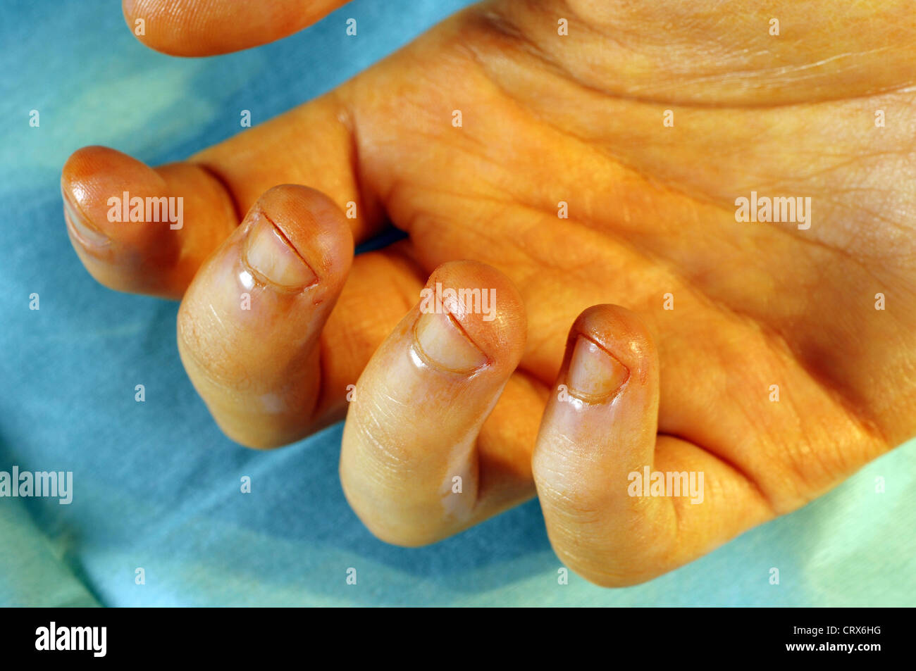 A hand swabbed with iodine before an operation to kill organisms ...