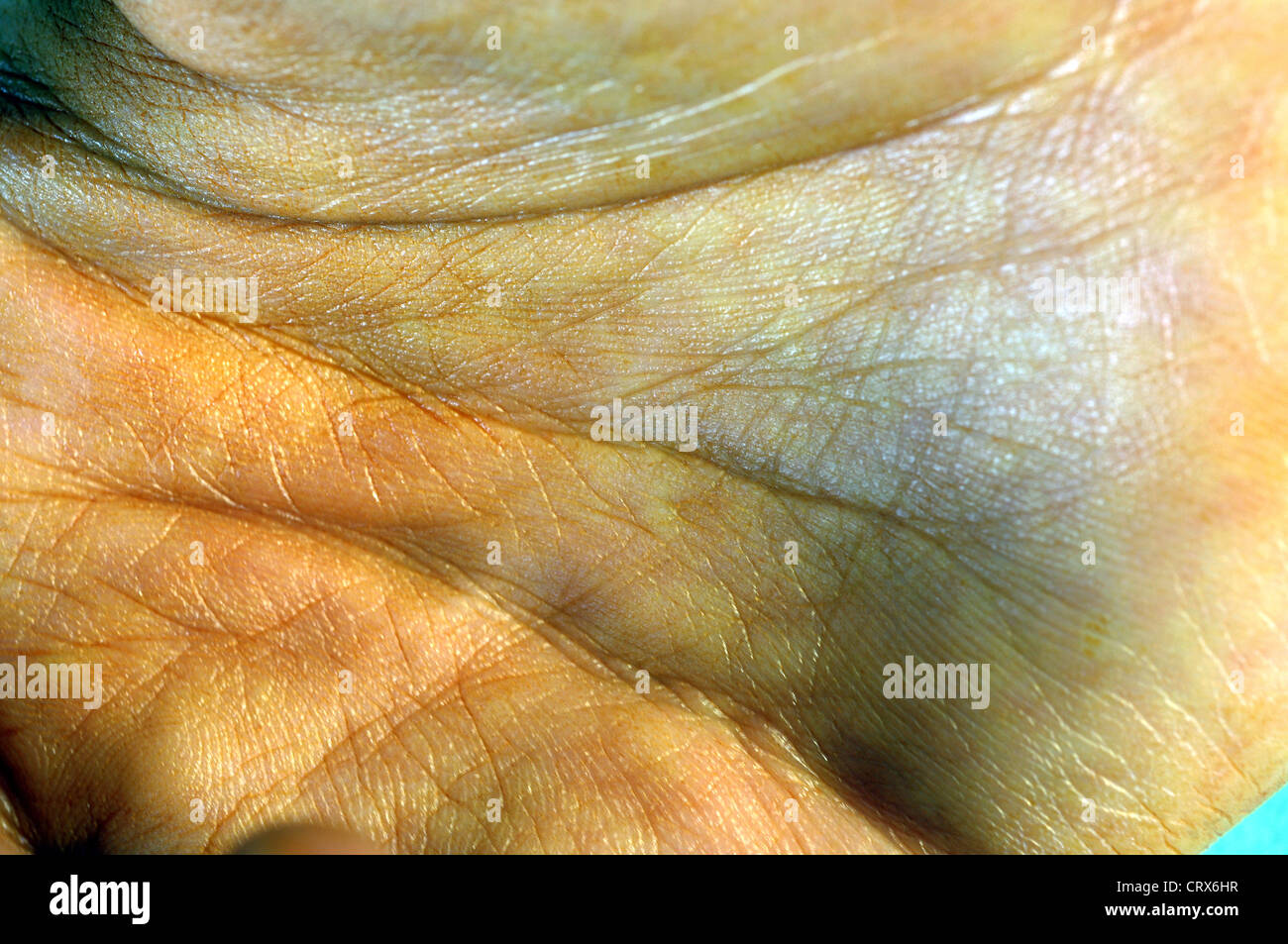 A hand swabbed with iodine before an operation to kill organisms ...