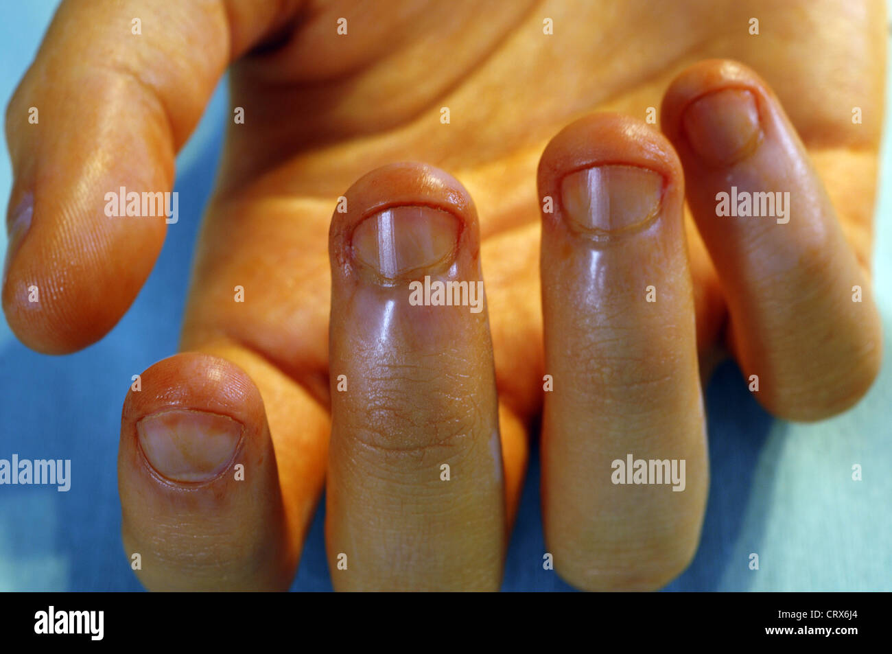 A hand swabbed with iodine before an operation to kill organisms ...