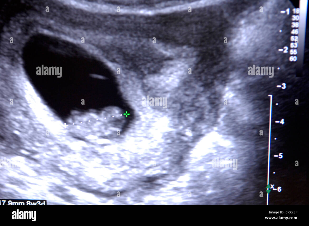 Antenatal Scan Stock Photos & Antenatal Scan Stock Images - Alamy