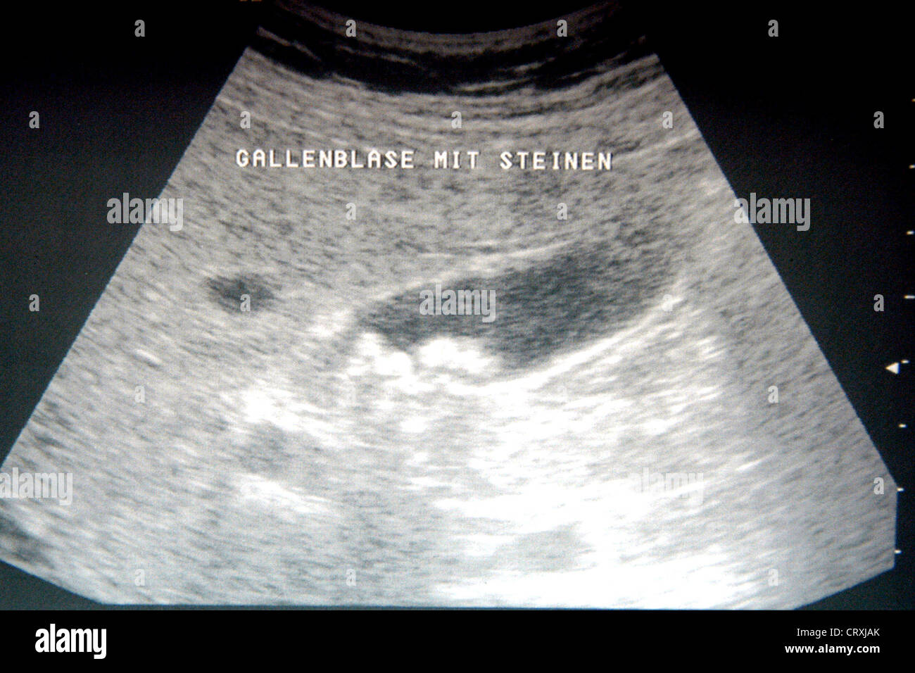 Gallbladder Ultrasound Stones