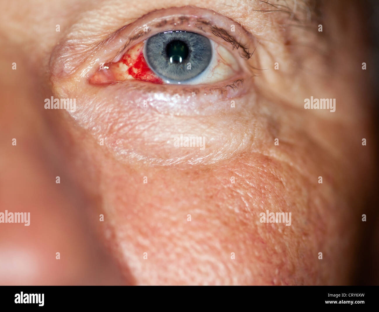Subconjunctival hemorrhage hi-res stock photography and images - Alamy