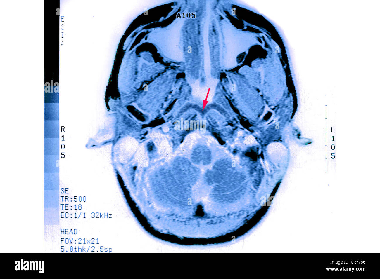 Tonsilla hi-res stock photography and images - Alamy