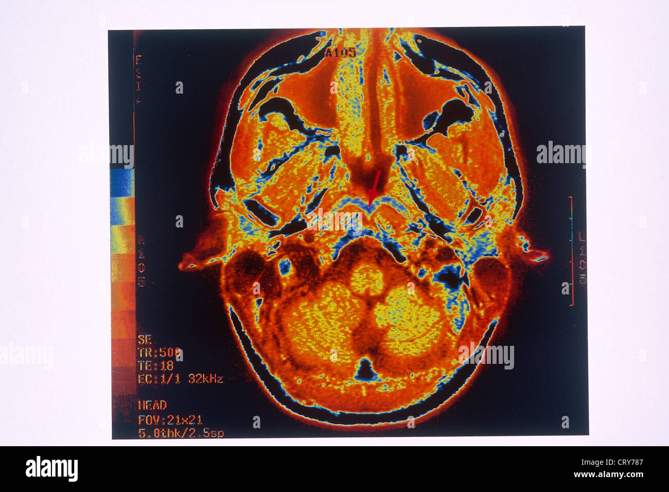 Tonsil examination hi-res stock photography and images - Alamy
