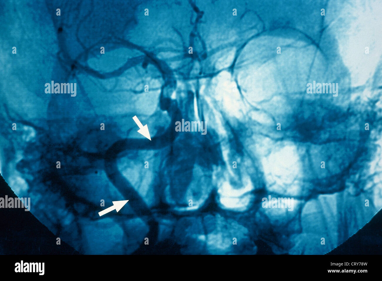 Vascular examination carotid artery hi-res stock photography and images ...