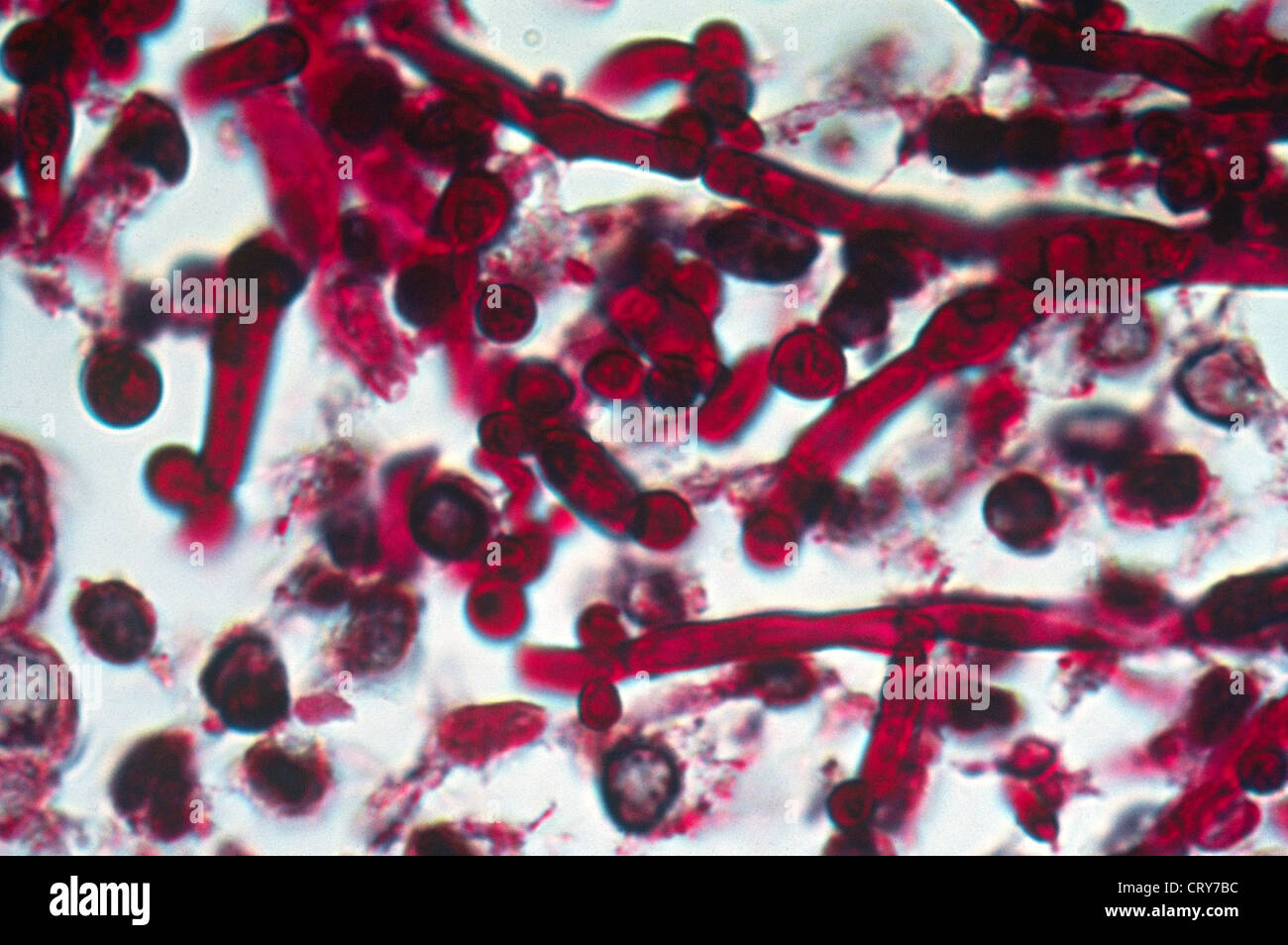 Moniliasis hi-res stock photography and images - Alamy