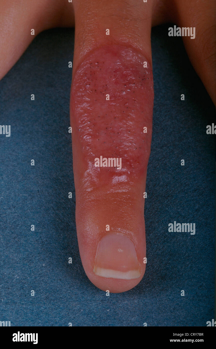 Whitlow finger hi-res stock photography and images - Alamy