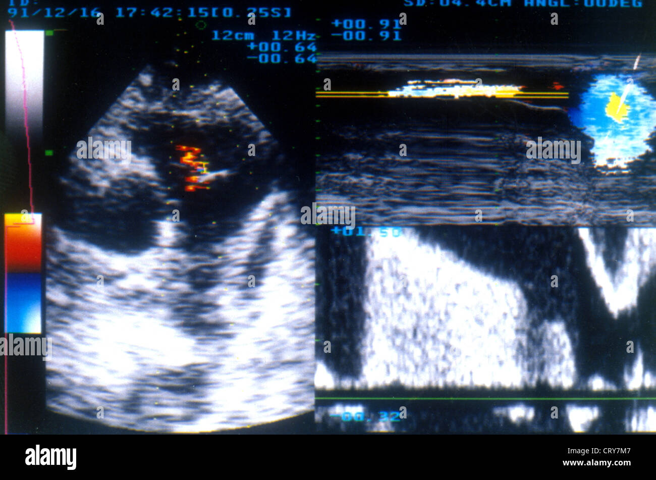 Lung failure hi-res stock photography and images - Alamy