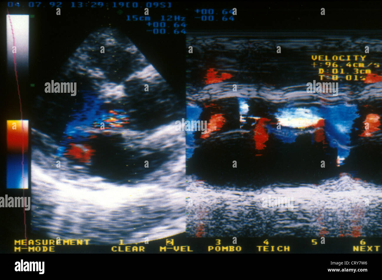 Aorta failure hi-res stock photography and images - Alamy