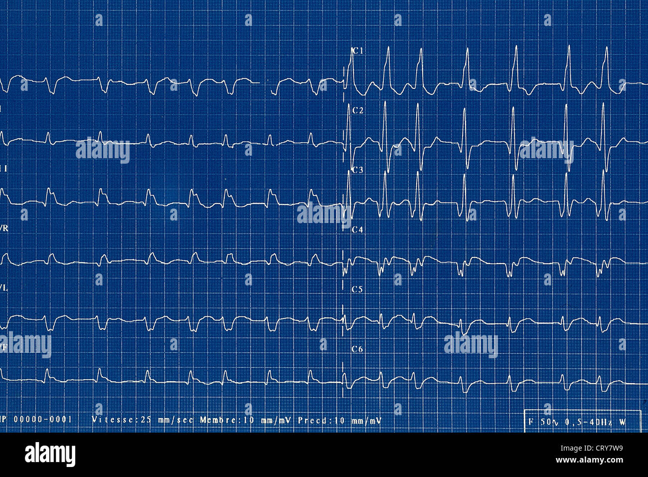 Atrial Fibrillation Stock Photos & Atrial Fibrillation Stock Images - Alamy